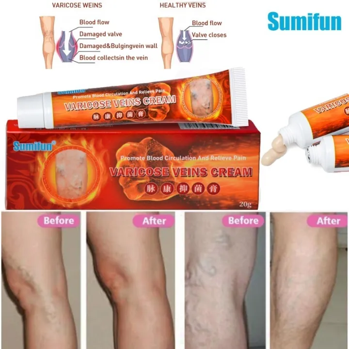 BMRS Varicose Vein Cream Vasculitis Phlebitis Spider Pain Relief ...