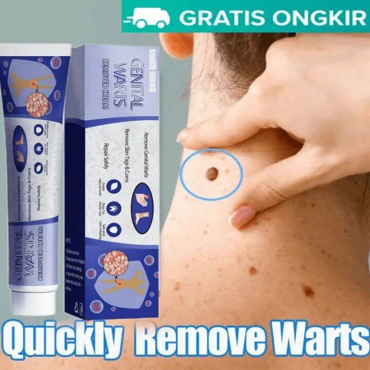 South moon Obat Kutil paling ampuh Wart Remover Skin Tag Remover Wart ...