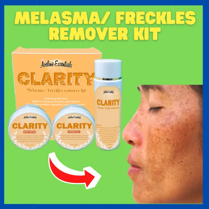 clarity pekas melasma remover set ( Pekas melasma / Pekas cream remover ...