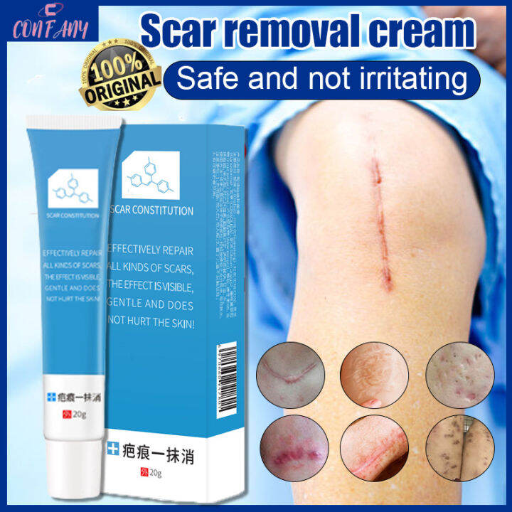 【Harmless to the skin】scar remover cream 20g Burn Bruises Stretch Marks ...