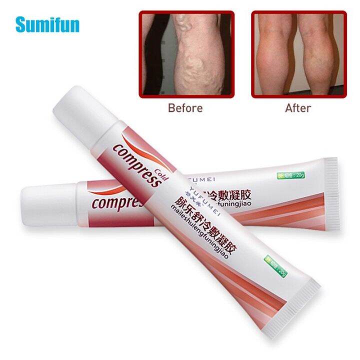 Varicose Veins Gel 1pcs Relieve Phlebitis Angiitis Natural Varicose ...