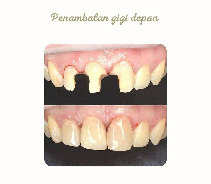 Tambal Gigi Berlubang Permanen Temptooth Bahan Gigi Palsu Original Penambal Gigi Patah Tambal ...