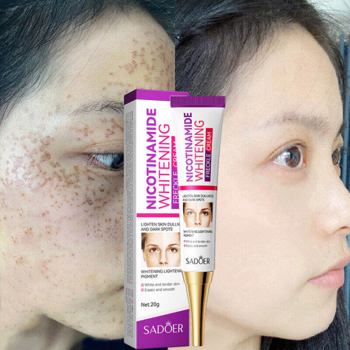 Fast Effective Freckle Removal Whitening Cream Face Moisturize Vitamin ...