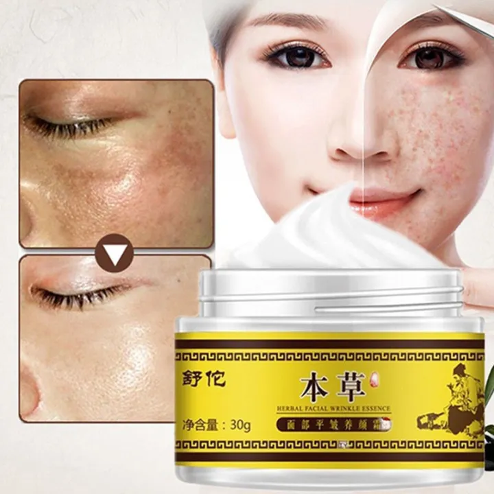 Freckle Removal Cream Dark Spot Facial Care Melasma Treatment Skin Care ...