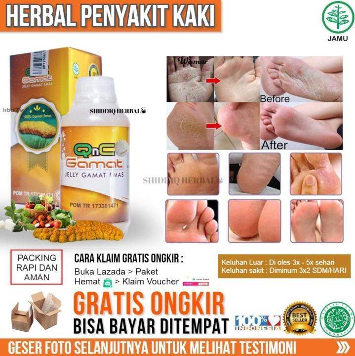 Obat Filariasis, Obat Filariasis Akut, Obat Filariasis Kronis, Obat ...