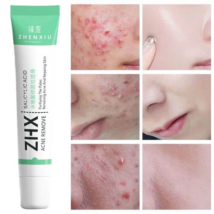 Salicylic Acid Acne Cream Powerful Repair Remove Acne Lighten Acne ...
