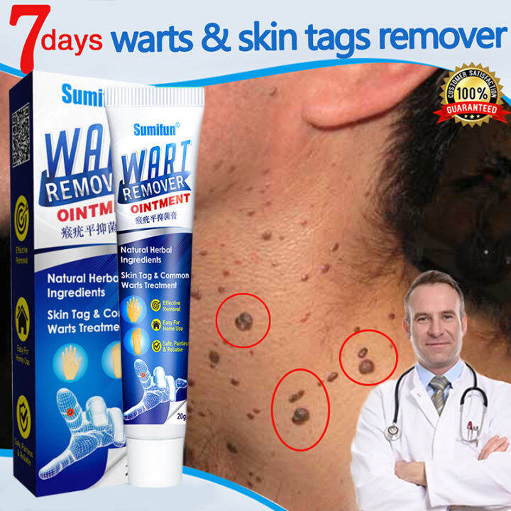 100% Effective Wart Remover Cream Magic Ointment Wart Treatment Cream ...