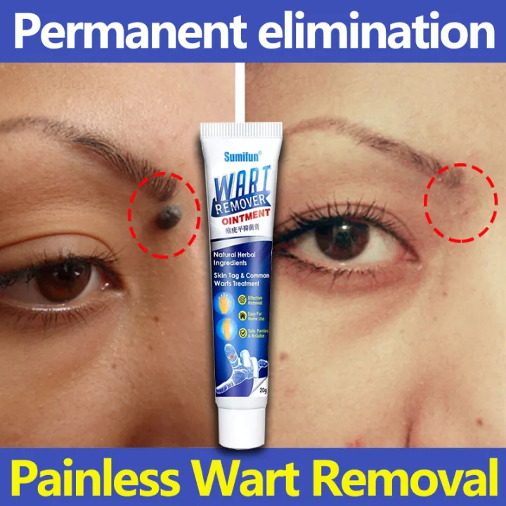 【Hot Sale】Warts Removal Original Cream Warts Magic Remover Wartz ...