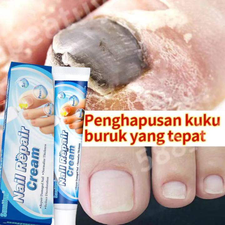 Obat Jamur Kuku Paling Ampuh Nail Repair Essence Serum Ajaib Viral di ...
