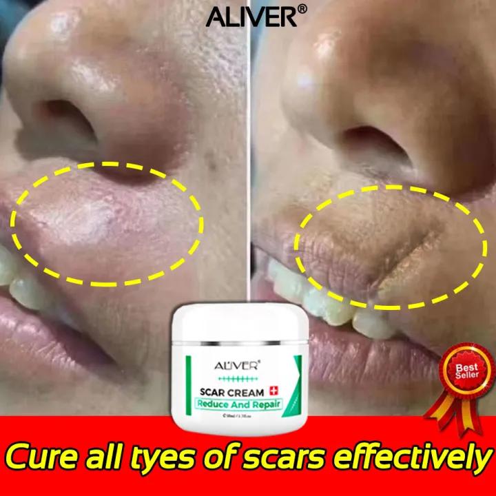 Solve the troubles caused by scars!ALIVER Scar Remover,Effectively ...