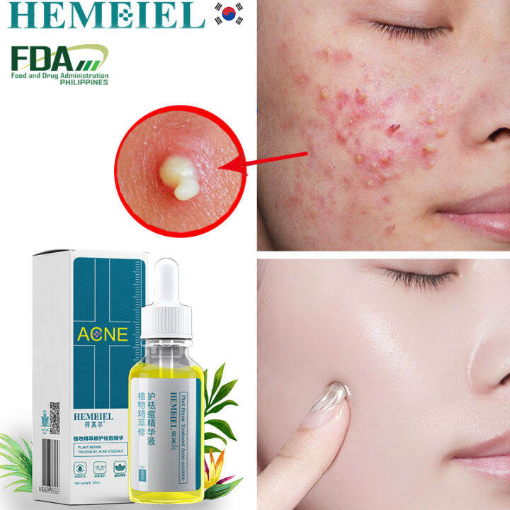 HEMEIEL Pimple Eraser/Benzoyl Peroxide/Acne Treatment Set/Pimple Eraser ...