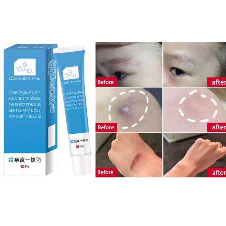 Scar Constitution Scar Removal Cream Gel Stretch Marks Remove Acne Spots Burn Surgical Scars ...