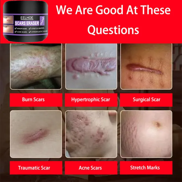 Medical Scar Cold Compress Gel Treatment Surgical Suture Scar scar ...