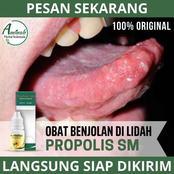 Obat Penyakit Benjolan di Lidah, Obat Alami Benjolan di Lidah Anak dan Dewasa, Benjolan di Bawah ...