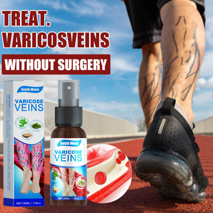 Healing Varicose Veins Treatment Spray30ml Relief Phlebitis Remedy Pain ...
