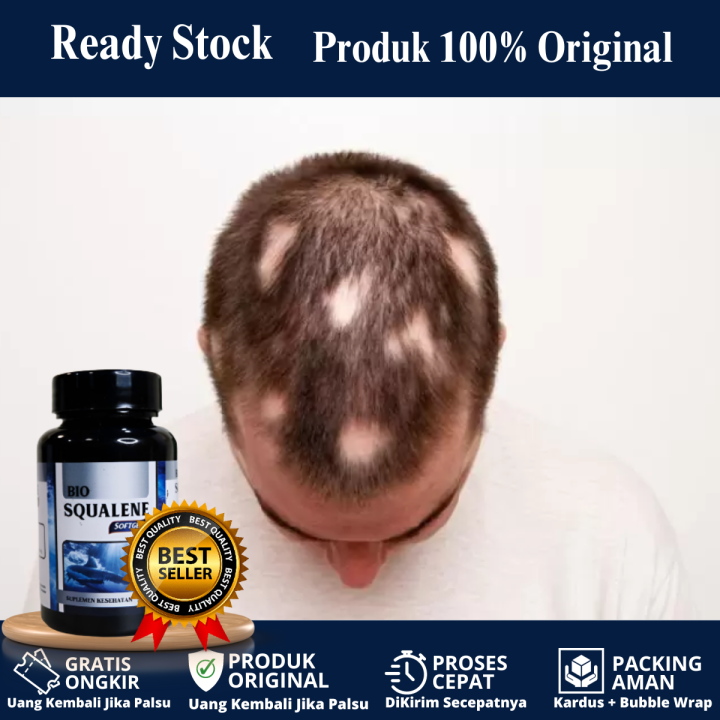 Obat Alopecia Areta, Obat Penumbuh Rambut Botak, Pitak, Obat Botak Kion ...