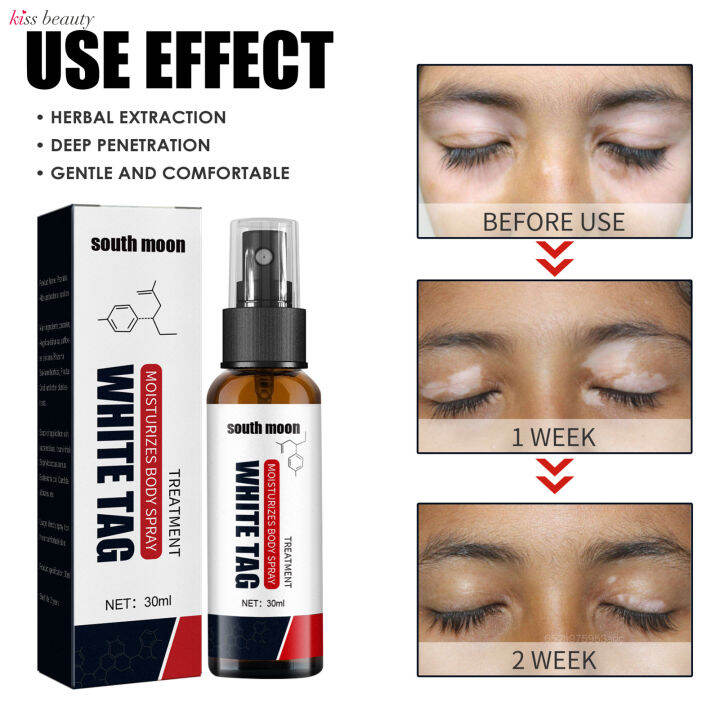 30ml Vitiligo Spray Treatment Deep Penetration Skin Care for Vitiligo ...