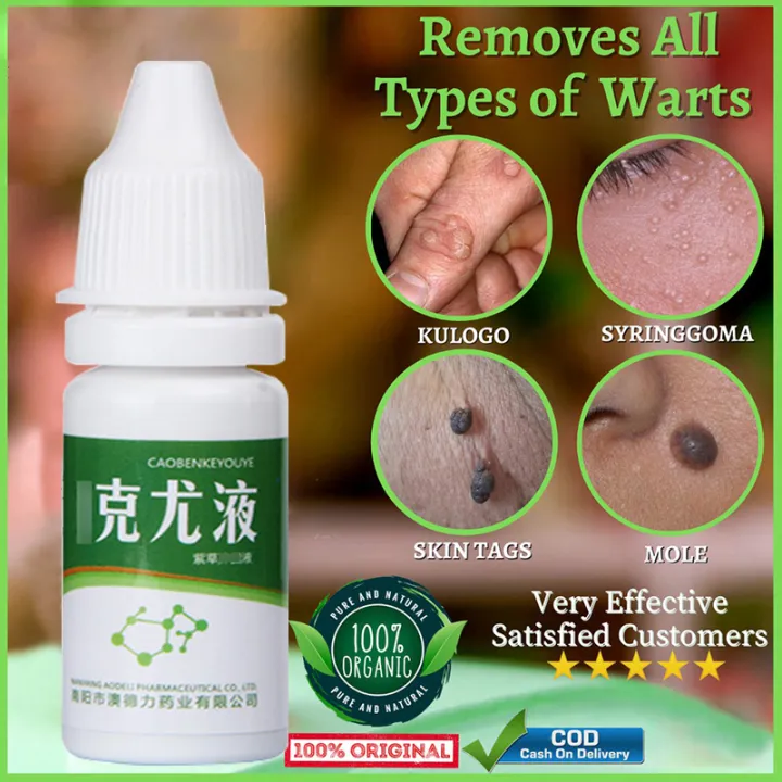 Warts Remover Original Liquid Warts Magic Remover Wart Ointment ...