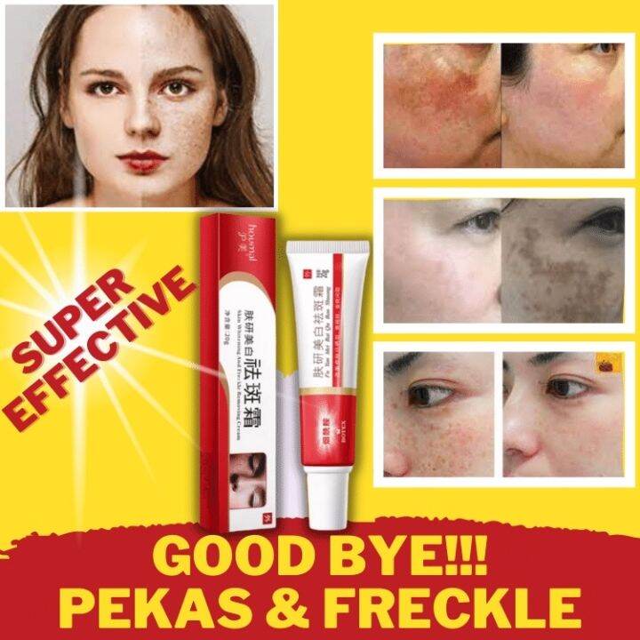 Melasma Pekas Remover Original Freckles 20g | Lazada PH