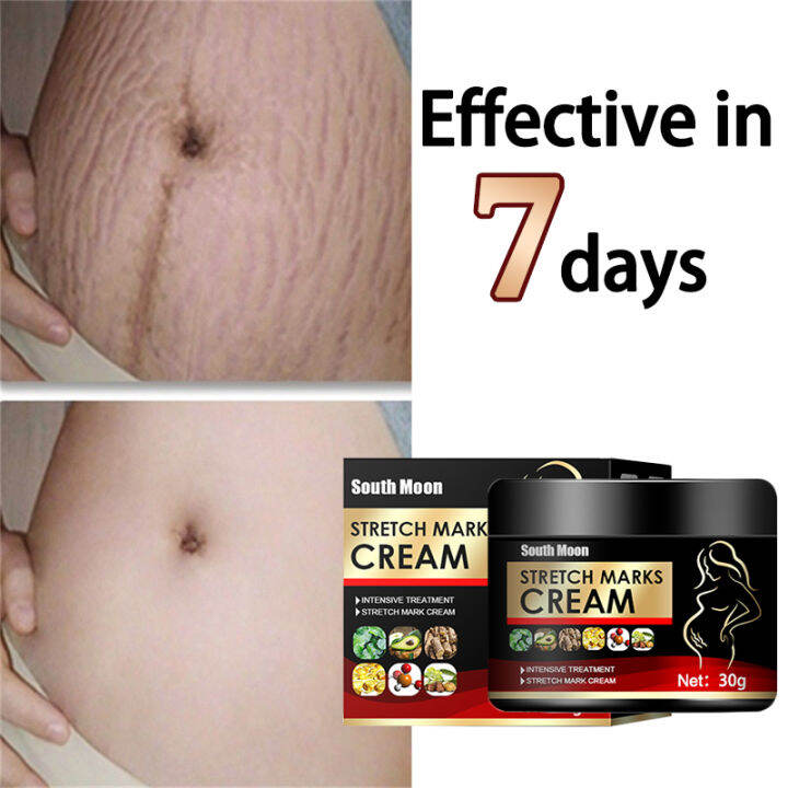 C C Outlet Stretch Marks Cream Remover Original For Pregnant Stretch ...