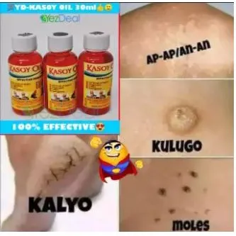 【Hot Stock】 SD-KASOY OIL Solution for WART REMOVER, SKINTAG REMOVER ...