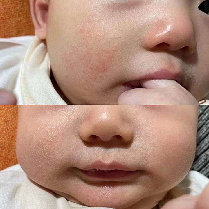 Salep eksim bayi dan anak, bebas hormon, new born , herpes keringat ...