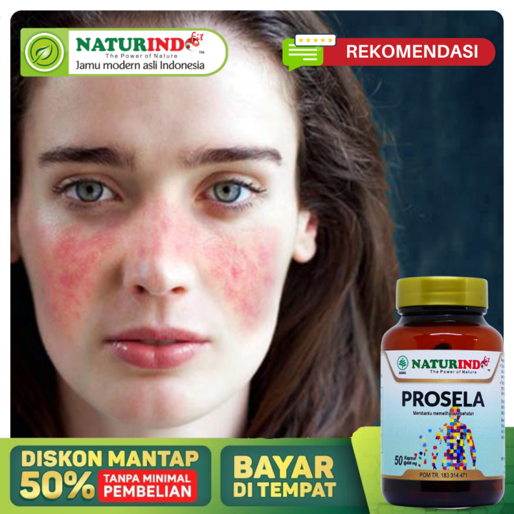 Obat Lupus Penyakit Autoimun Nyeri Dan Kaku Pada Sendi Ruam Kulit Gatal ...