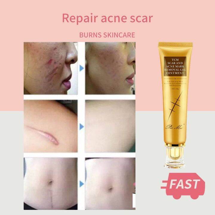special offer Scar Removal Cream piklat peklat remover acne scar ...