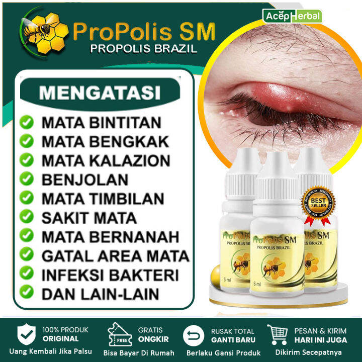 Obat Mata Bintitan Kalazion Pada Anak Dan Dewasa Mata Timbilan Mata ...
