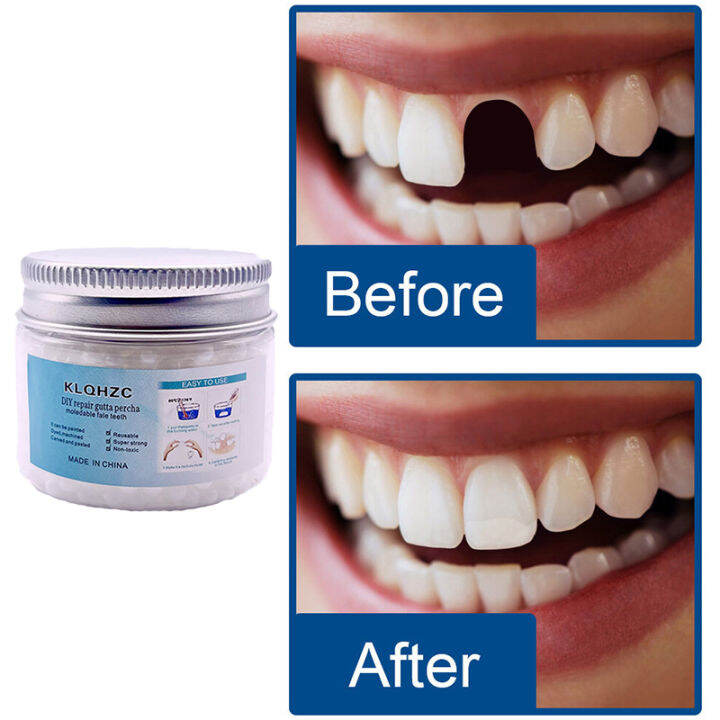【Fast filling】DIY Tooth Repair Kit Temporary Teeth Restoration 50g ...