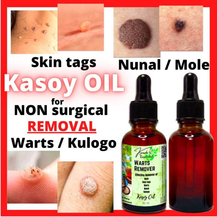 Warts Mole Remover 30ml Pure Kasoy OIL also for Butlig Kulugo Nunal by ...