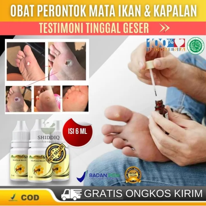 Obat Untuk Menghilangkan Mata Ikan Sampai Ke Akar, Obat Alami Perontok ...