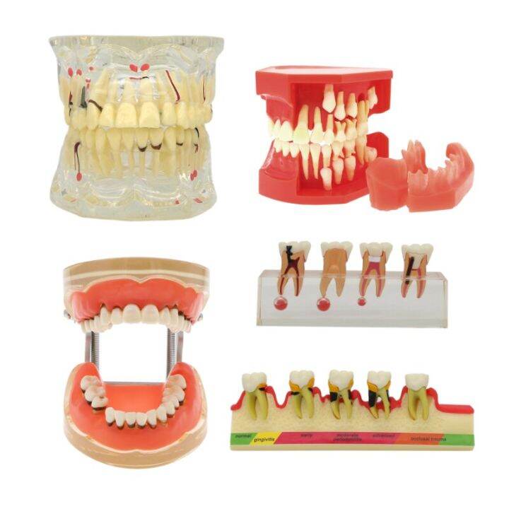 Dental Pathological Typodont Teeth Model Periodontics Implant ...