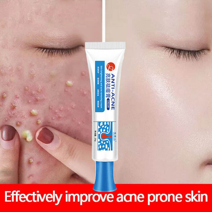 Remove Pimples Quickly Remover Acne Cream Fades Acne Marks Repairs Acne Pits Facial Scar Care ...