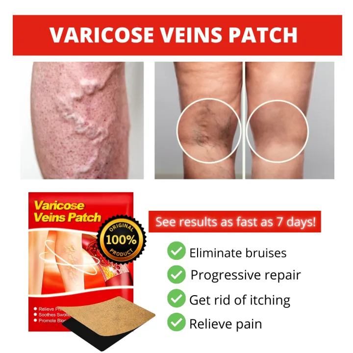 💯 Varicose Veins Plaster Chinese Medical Patch Vasculitis Phlebitis ...