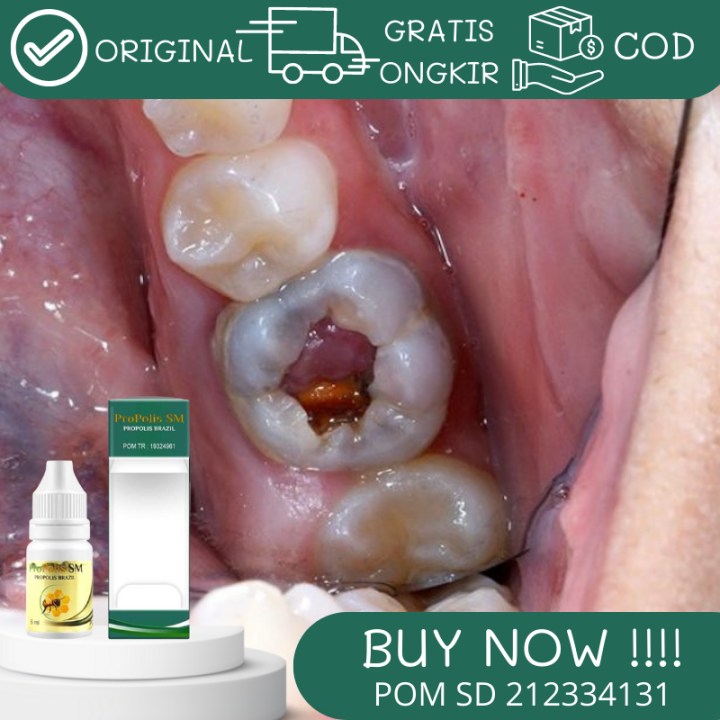 Obat Polip Gigi, Obat Polip Gigi Anak Dan Dewasa, Polip Pulpa Gigi ...