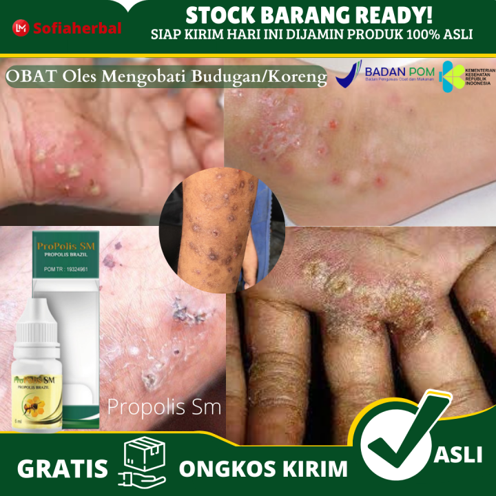 Obat Budug Bernanah, Gatal Bernanah, Gatal Budugan, Budug Di Tangan ...