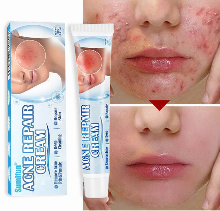 Original 30g Remove Pimples Quickly Pimple Remover Acne Cream Fades Acne Marks Repairs Acne Pits ...