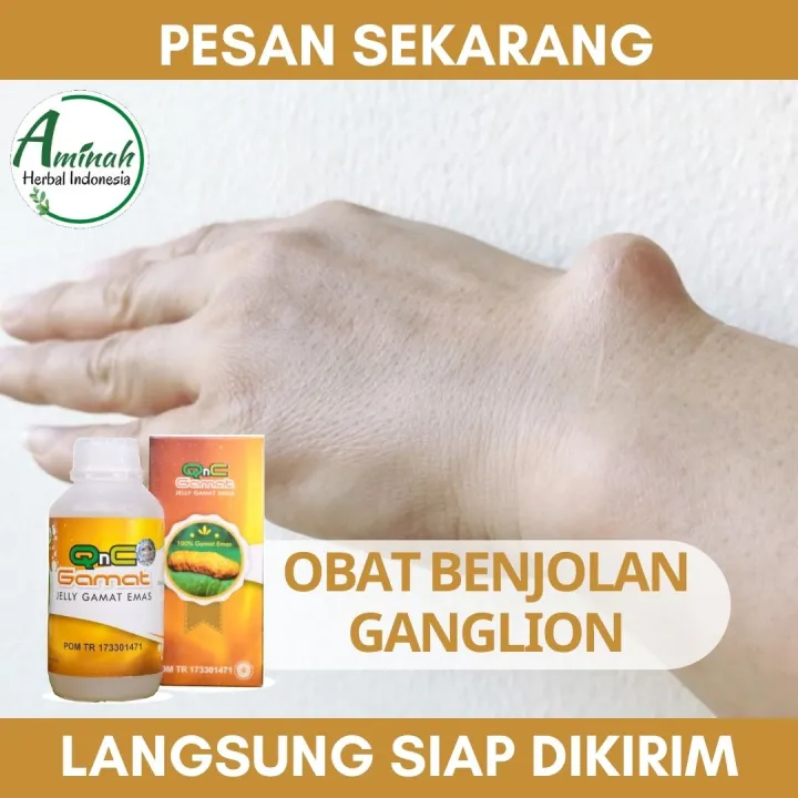 Obat Penyakit Ganglion - Obat Benjolan Ganglion, Obat Kista Ganglion ...