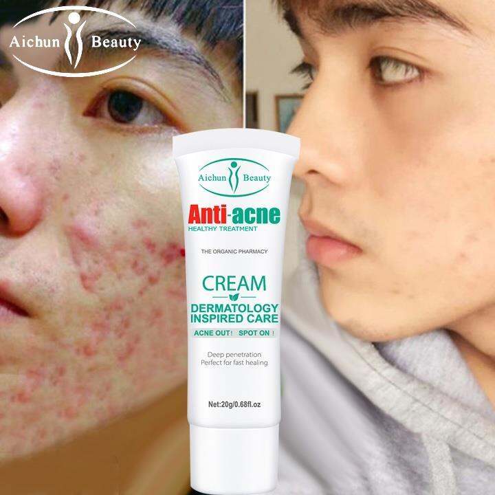 Acne Pimple marks remover cream Anti dark spots Treatment whitening ...