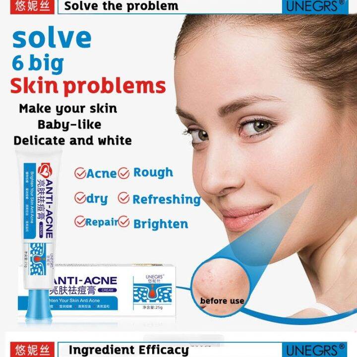 100% Original Acne Pimples Remover Cream Pimple Remover Acne Cream ...