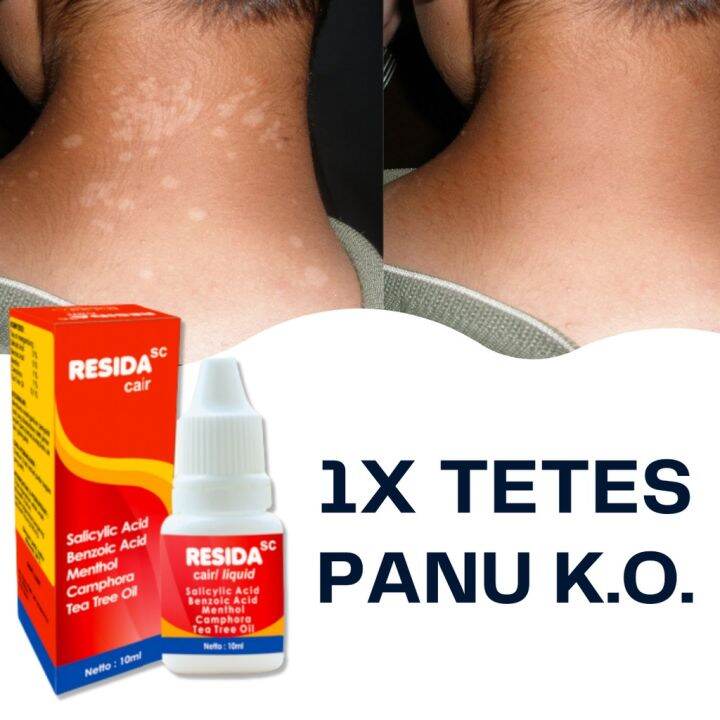 RESIDA CAIR / SEBAGAI PENGGANTI KALPANAK CAIR ORIGINAL OBAT KULIT PANU ...