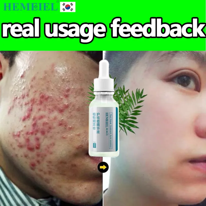 HEMEIEL Pimples & Acne Remover Best Seller/Pimple Eraser/Acne Scar ... HEMEIEL Pimples & Acne Remover Best Seller/Pimple Eraser/Acne Scar ...
