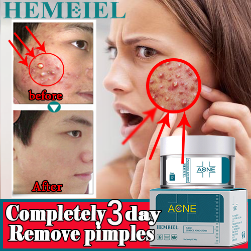 HEMEIEL Anti Acne And Pimples/Gamot Sa Pimples Cream/Pampatanggal Ng ...