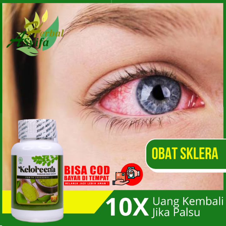 Obat Sklera - Obat Herbal Sklera Mata, Obat Gangguan Pada Sklera ...