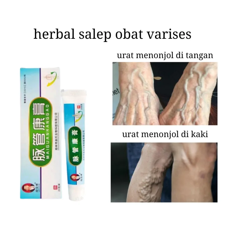 Salep Untuk Varises Penghilang Urat Tangan - Kerim Buat Menghilangkan ...