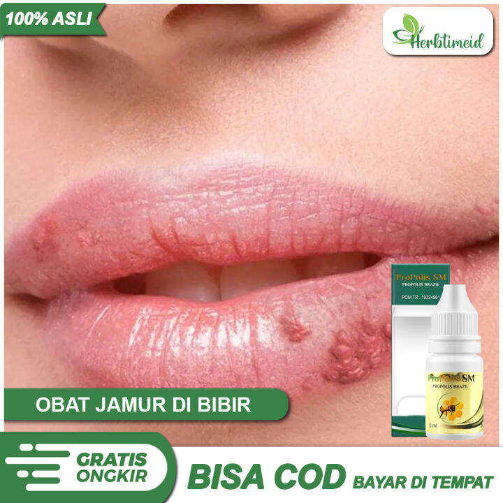Obat Jamur di Bibir - Penghilang Bercak Putih di Mulut Berair Herpes ...