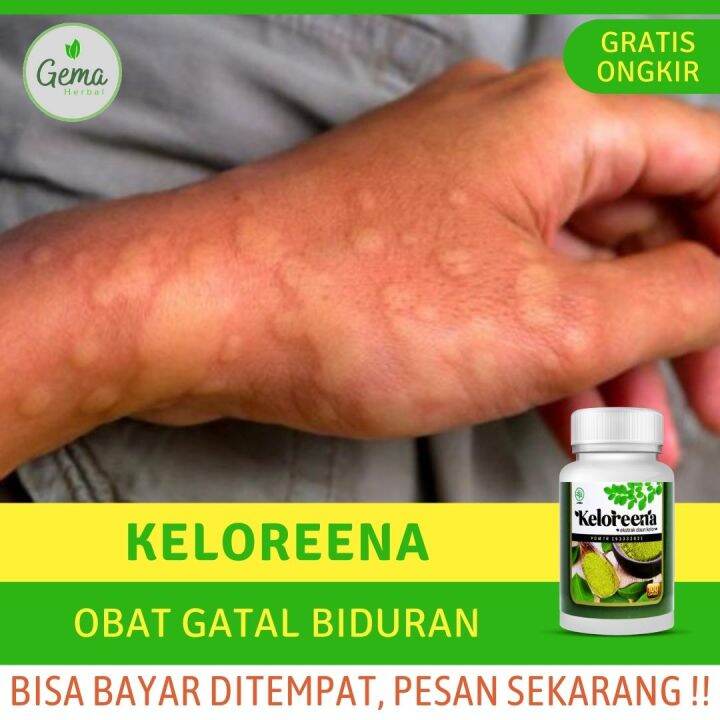 Obat Herbal Biduran Aman Tanpa Efek Samping - Obat Gatal Biduran - Obat ...