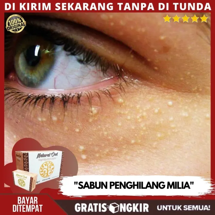 Obat Milia Di Wajah Natural Oud - Bintik Bintik Di Wajah, Buat ...