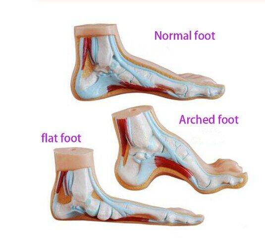 Human Foot Model Foot Muscles Flatfoot Talipes cavus Bow foot model ...